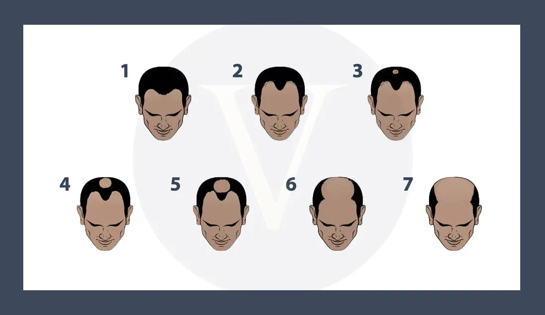 Norwood Hamilton Scale: Hair Loss Stages 1–7 & Hairline
